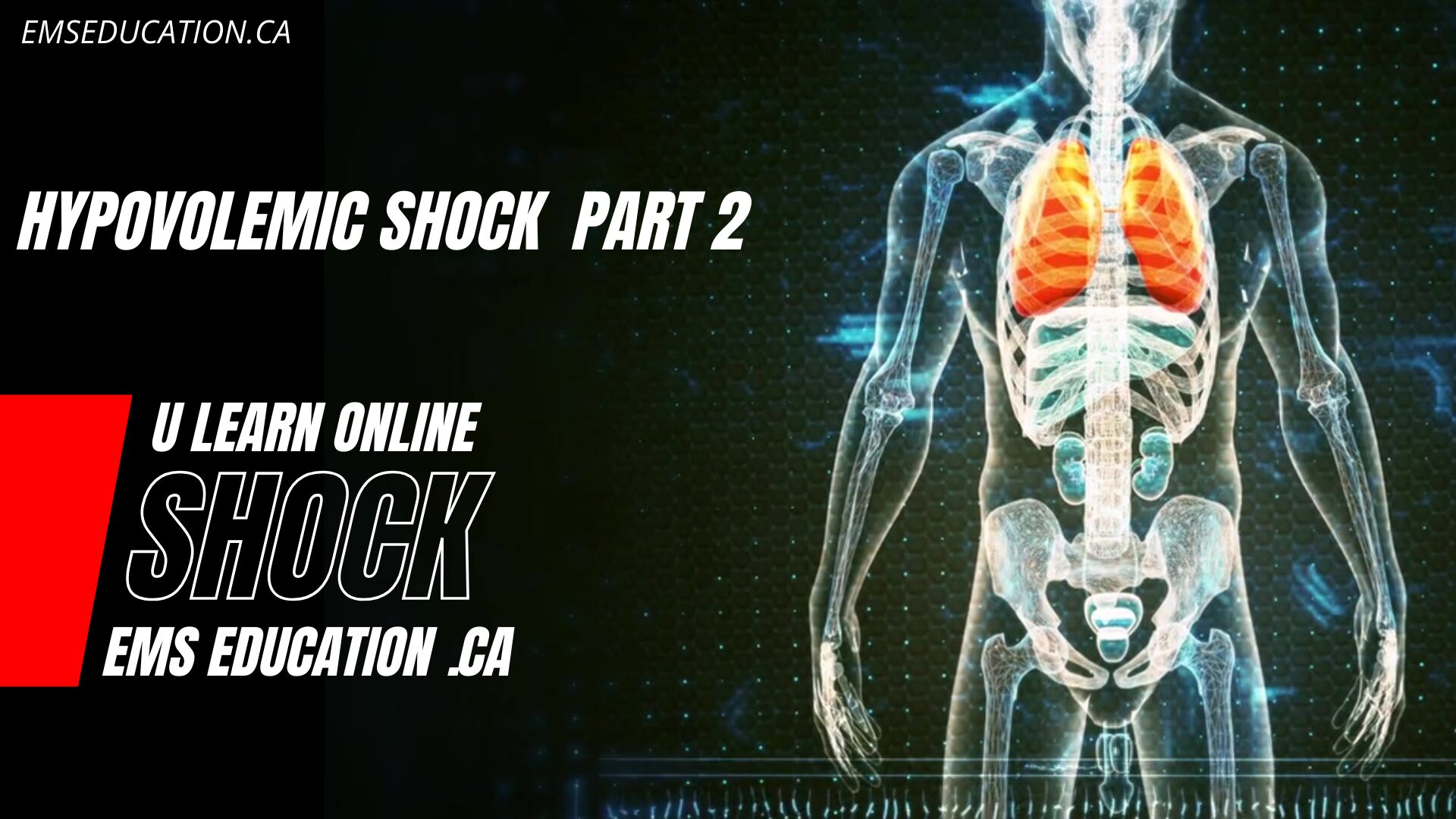 Hypovolemia Shock - Part 2 - U Learn Online